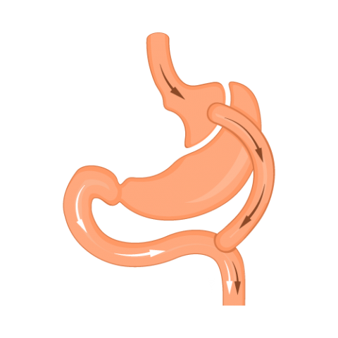 Laparoscopic Roux en Y Gastric Bypass - Dr. Rohit Kumar
